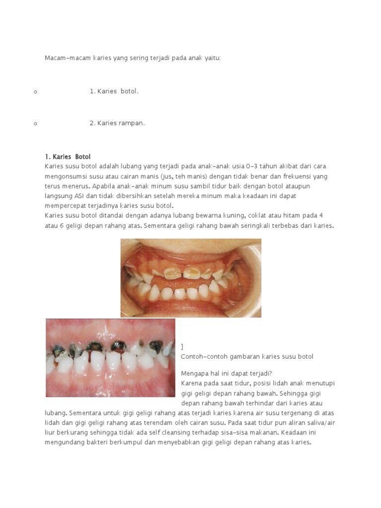 Macam Macam Karies Pada Anak | PDF