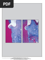 Miller Classification of Marginal Tissue | PDF | Periodontology ...