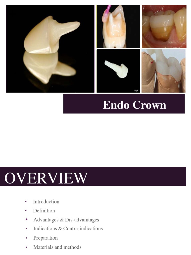 Endo Crown 171206093622 PDF | PDF | Mouth | Dentistry