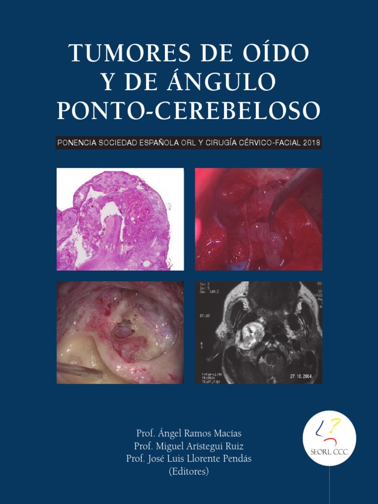 SEORL 2018 TUMORES DE OIDO WEBok PDF | Descargar gratis PDF | Cáncer ...