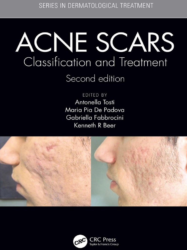 Acne Scars Classification and Treatment | PDF | Scar | Inflammation