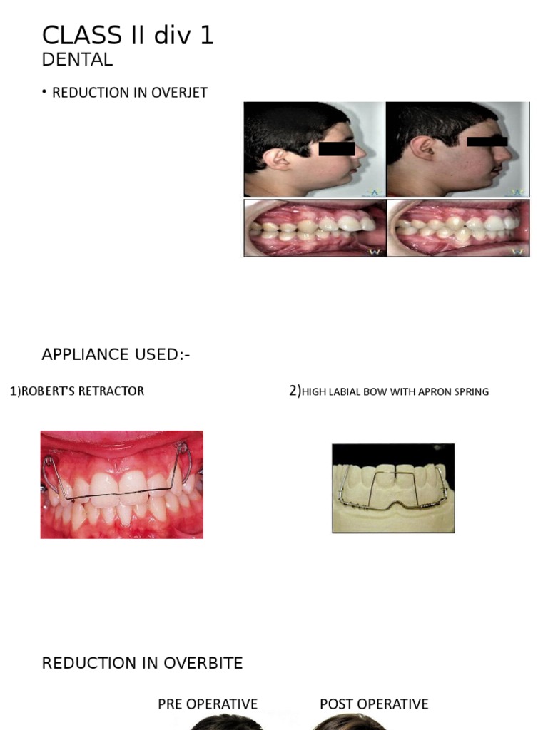 Class Ii Div 1: Dental | PDF