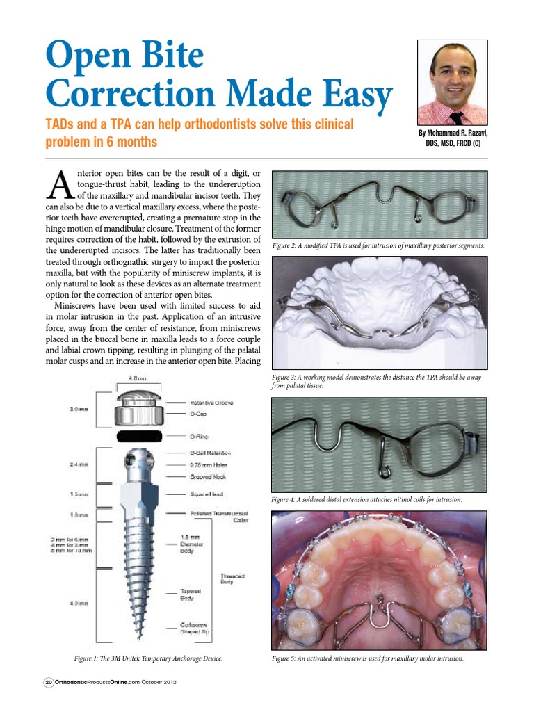 TPA and TADs for Open Bite Correction | PDF | Orthodontics | Dentistry ...