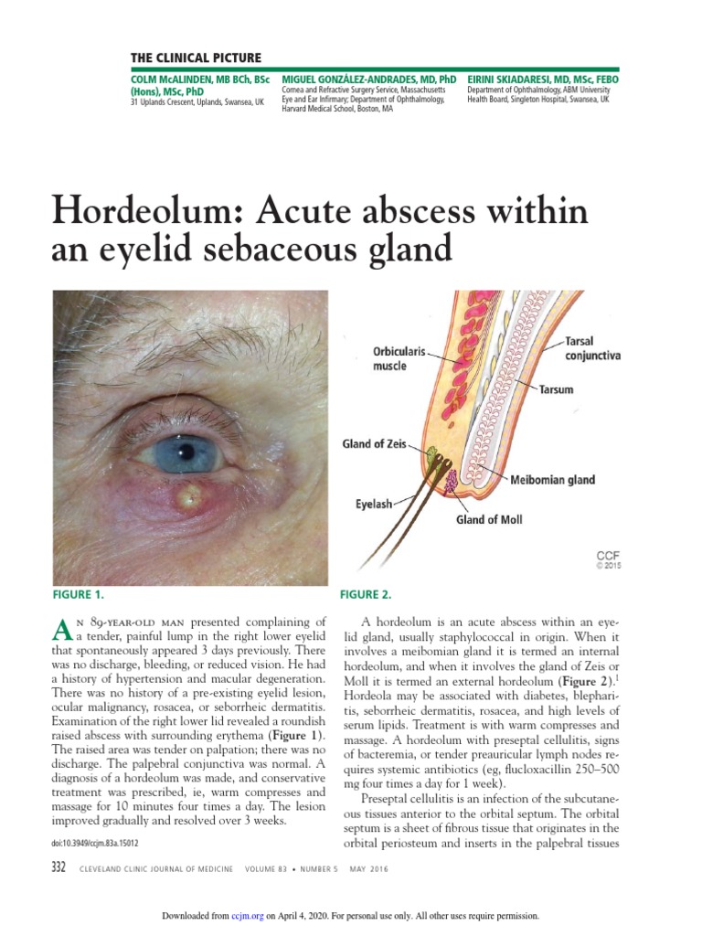Hordeolum: Acute Abscess Within An Eyelid Sebaceous Gland: The Clinical ...