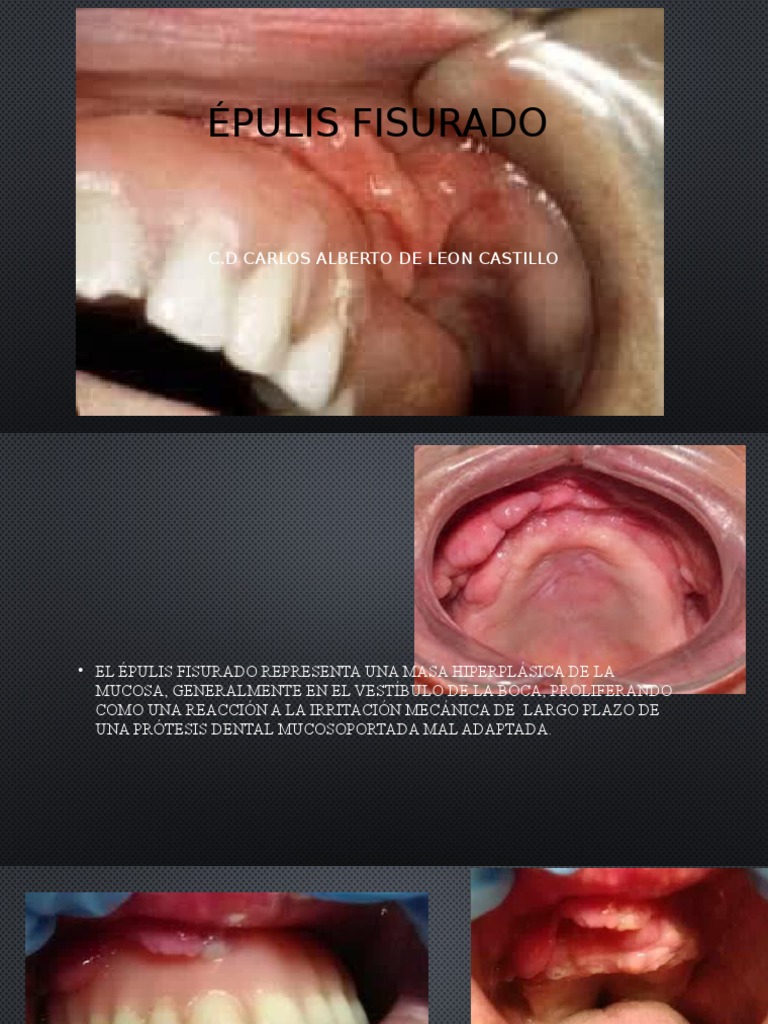 Epulis Fisurato | PDF | Ciencias de la Salud | Anatomía