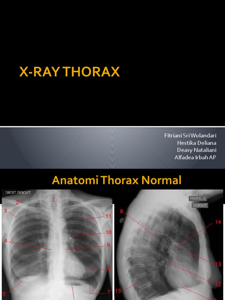 Interpretasi Foto Rontgen Thorax Normal | PDF