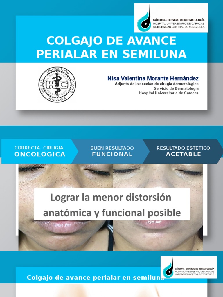 Colgajo de Avance Perialar en Semiluna | PDF