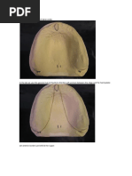 Removable Prosthetics: Crossbite Set-Up Typ Posterior Teeth | PDF ...