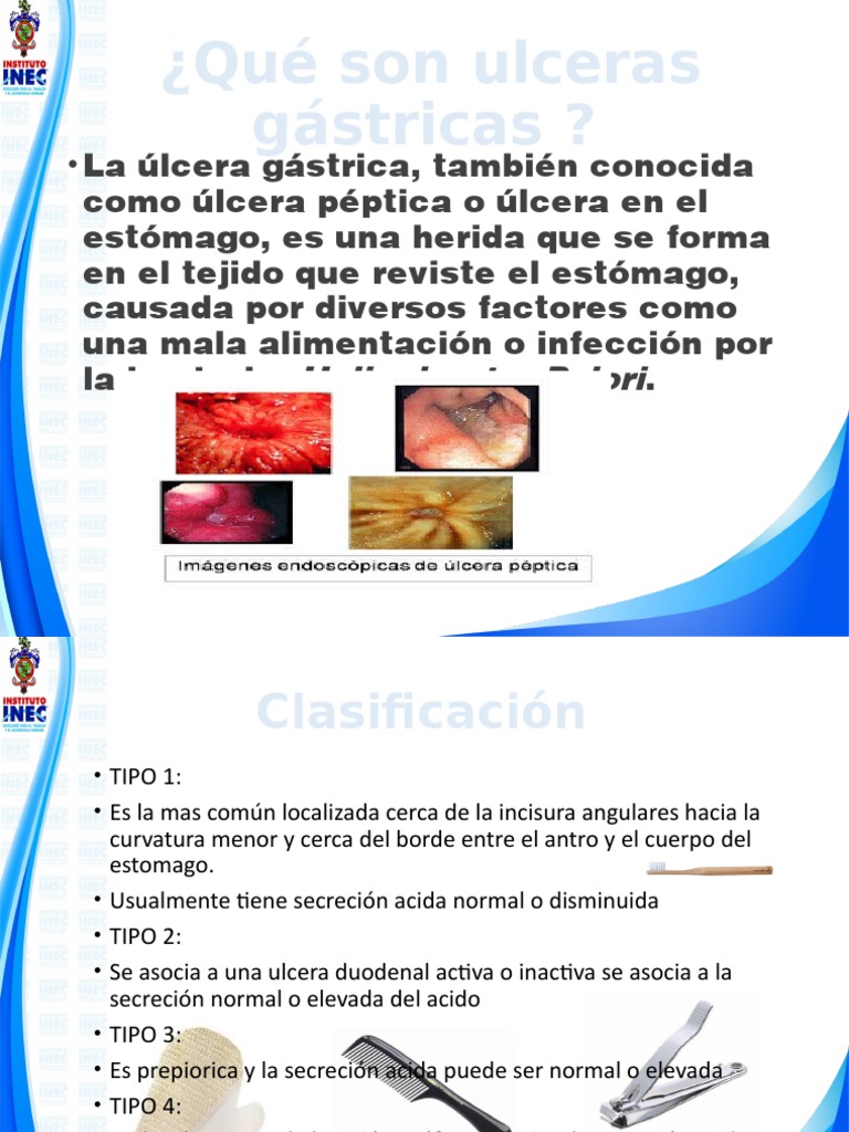 Clasificación y tratamiento de úlceras gástricas | PDF | Estómago | Drogas