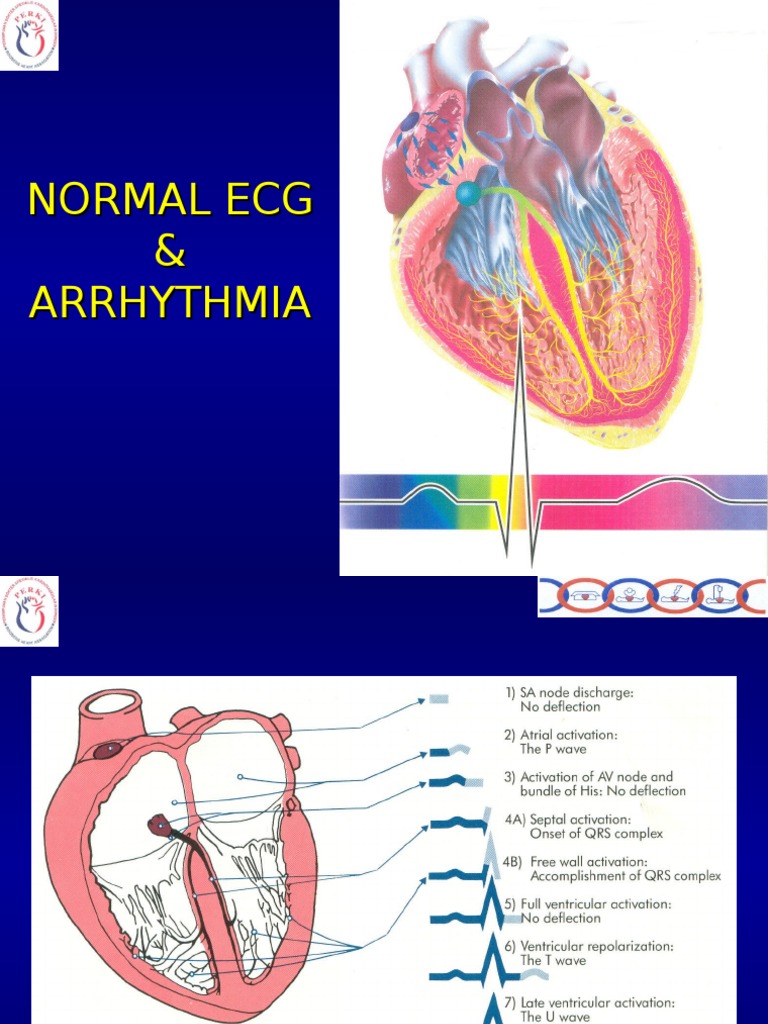 ECG Arrhythmia | PDF | Electrocardiography | Cardiovascular Physiology