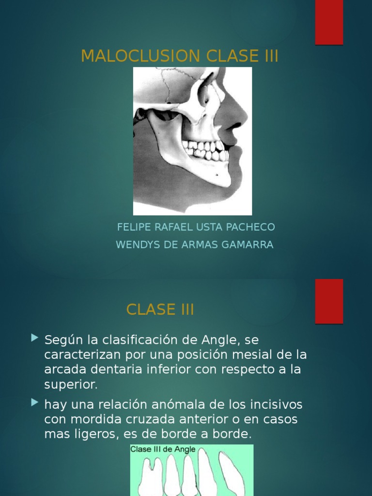 Maloclusión Clase III según Angle | PDF | Odontología | Boca