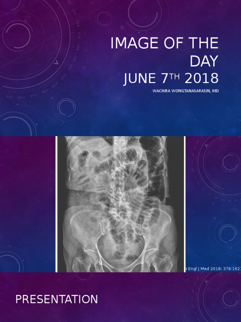 Colon Cut-Off Sign in Abdominal Pain | PDF | Science & Mathematics