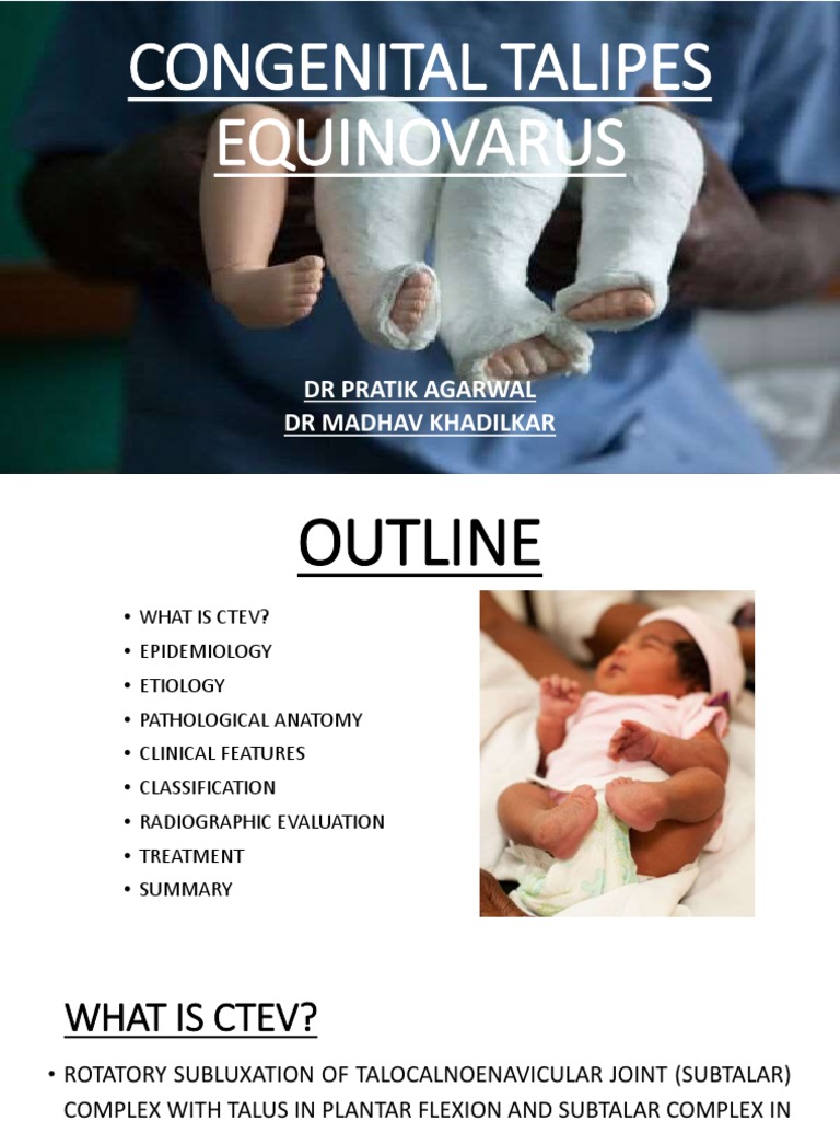 Congenital Talipes Equinovarus: DR Pratik Agarwal DR Madhav Khadilkar ...