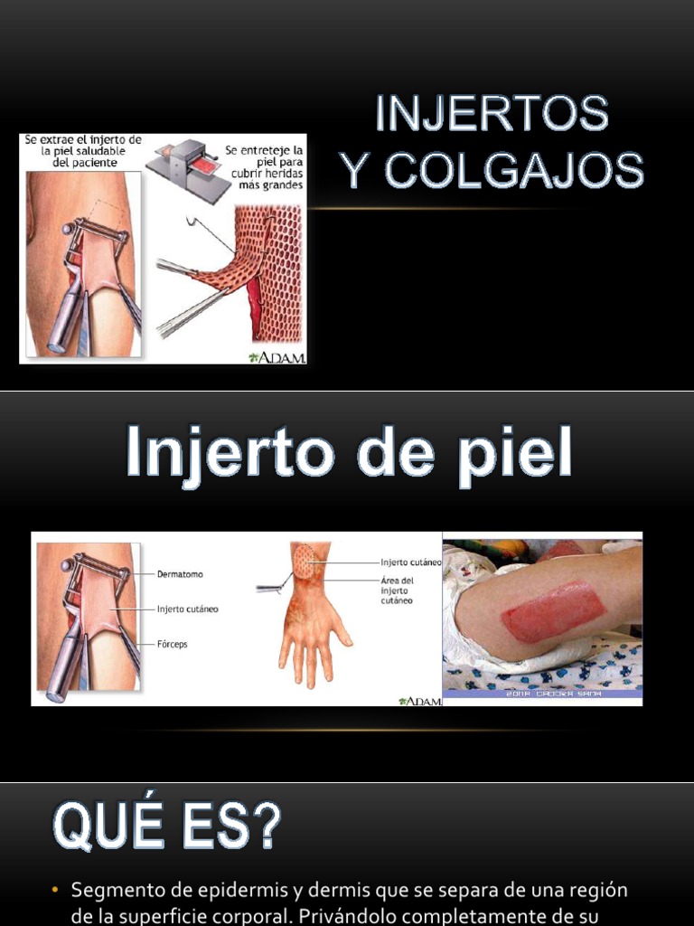 Injertos 160328170210 | PDF | Piel | Herida