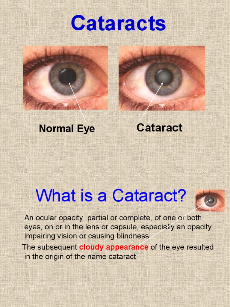 Cataracts: Cataract | PDF | Cataract | Facial Features