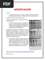 Tecnica de Apexificacionr | PDF
