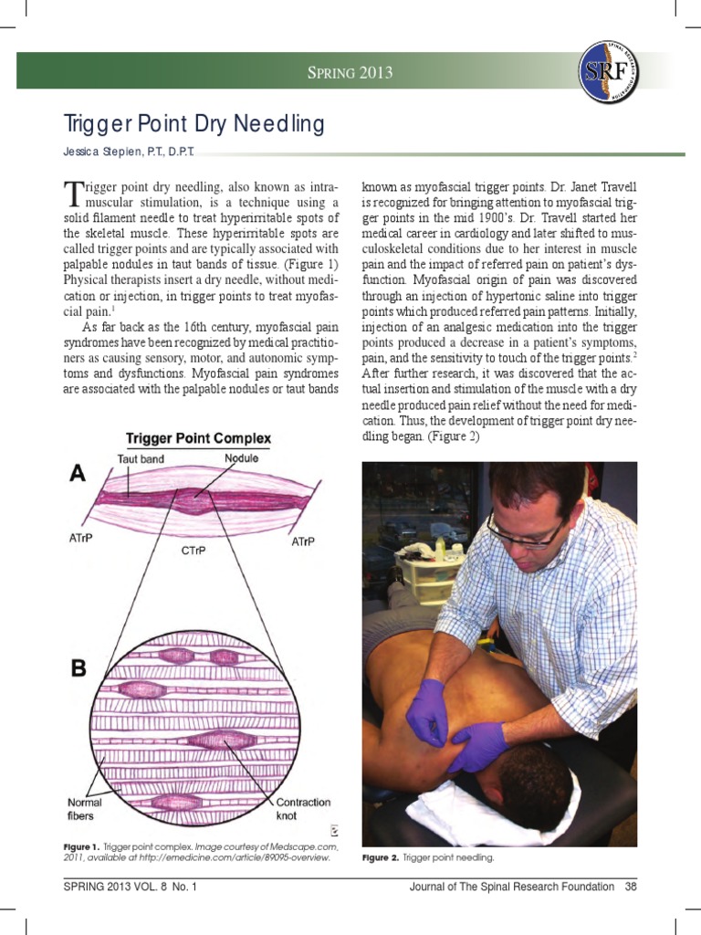 Dry Needling Article SRF Journal | PDF | Myofascial Trigger Point ...