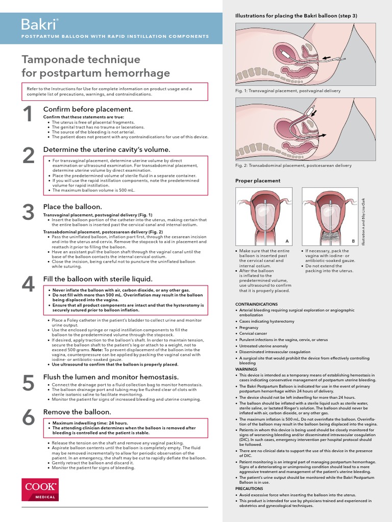 Bakri: Tamponade Technique For Postpartum Hemorrhage | PDF | Vagina ...
