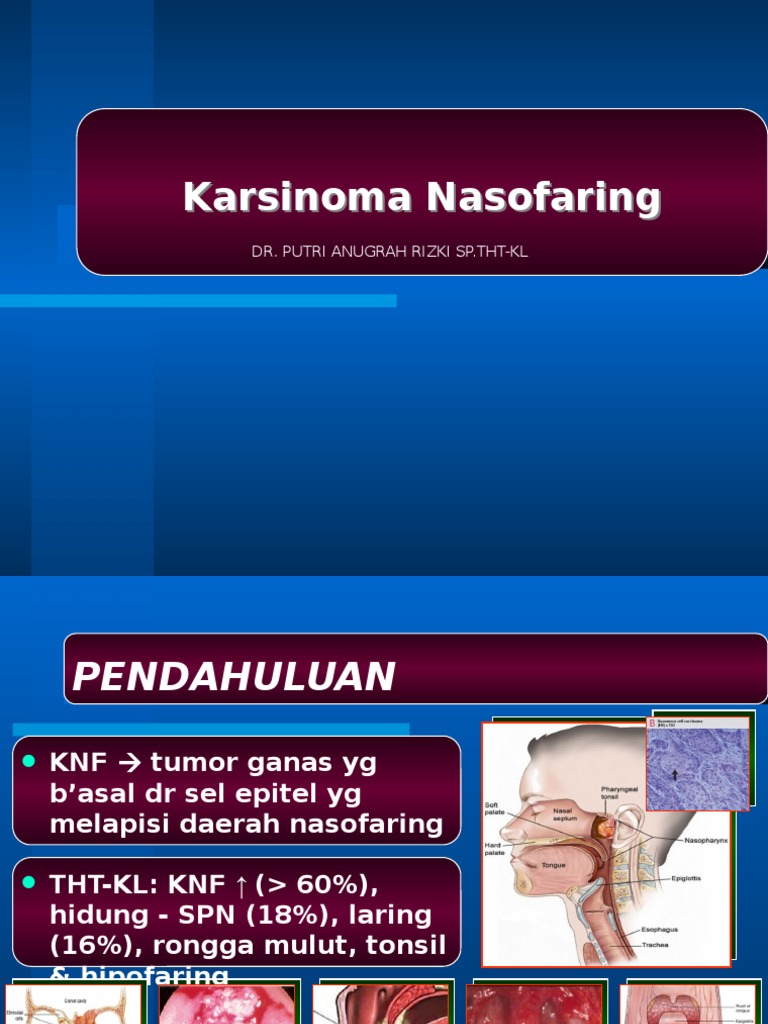 01 - Karsinoma Nasofaring | PDF
