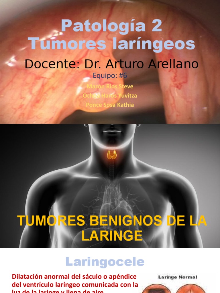 Laringe Tumores | PDF | Sarcoma | Metástasis