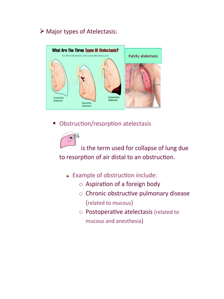 Understanding Atelectasis Types | PDF