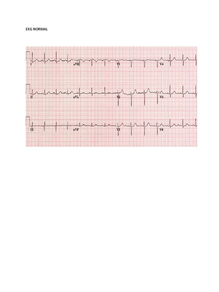 Ekg Normal | PDF