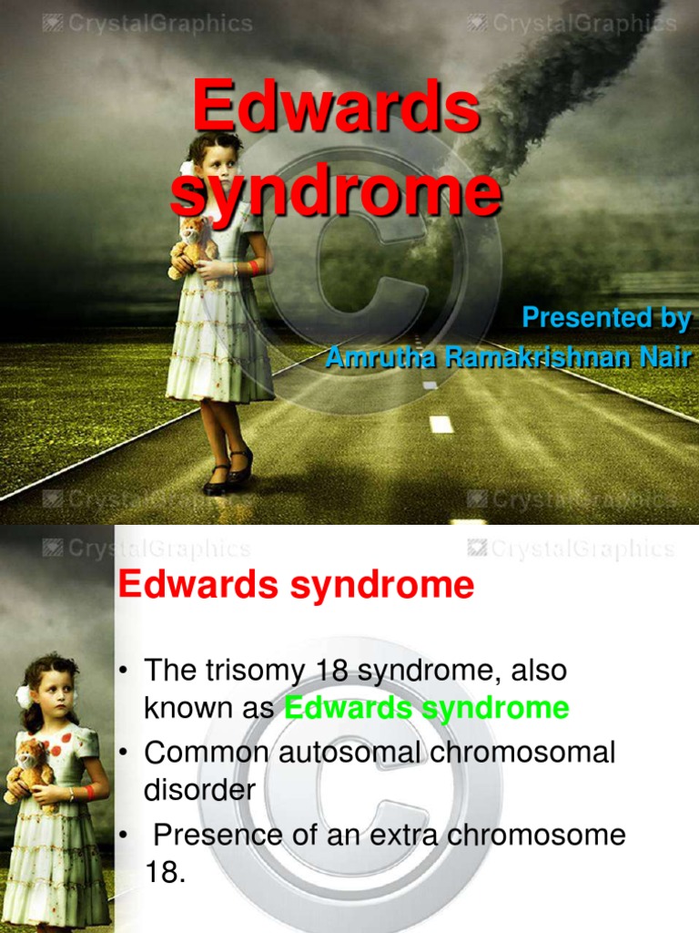 Edwards Syndrome: Presented by Amrutha Ramakrishnan Nair | PDF | Human ...