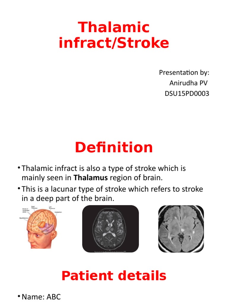 Thalamic Stroke: Diagnosis and Treatment | PDF | Stroke | Human ...