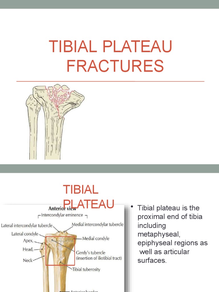 Tibial Plateau Fracture Overview | PDF | Skeletal System | Joints