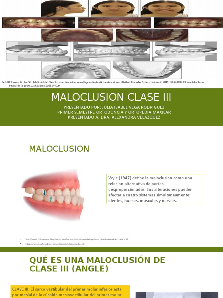 Maloclusión Clase III: Diagnóstico y Tratamiento | PDF | Ortodoncia ...