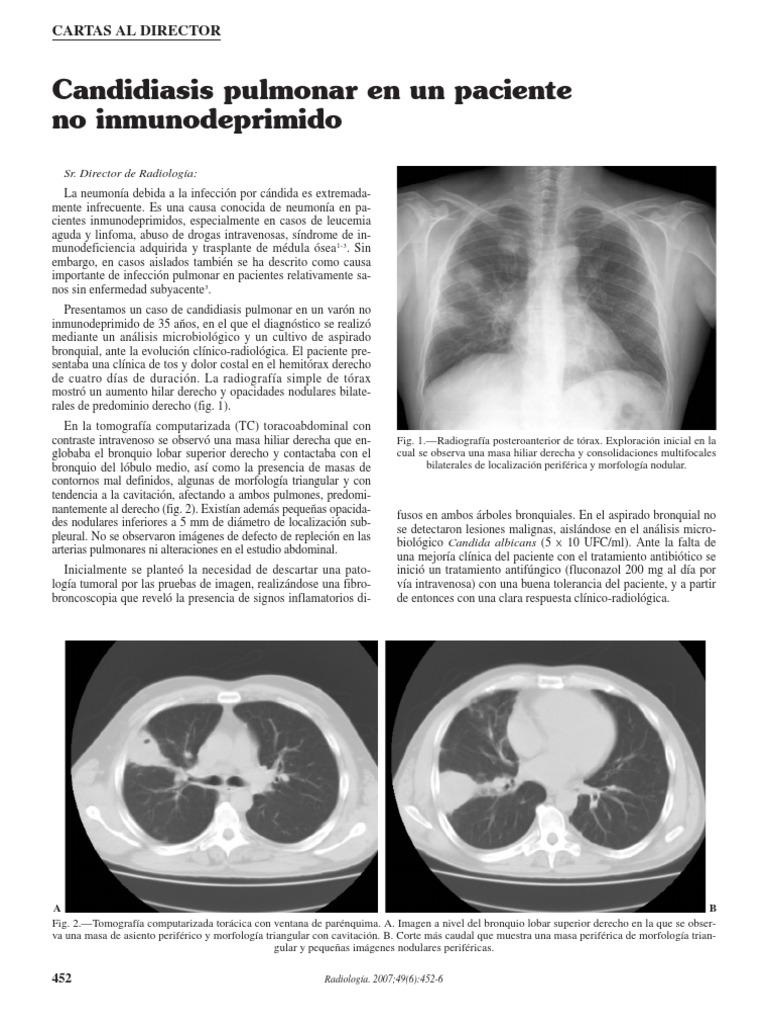 Candidiasis Pulmonar en Un Paciente No Inmunodeprimido: Sr. Director de ...