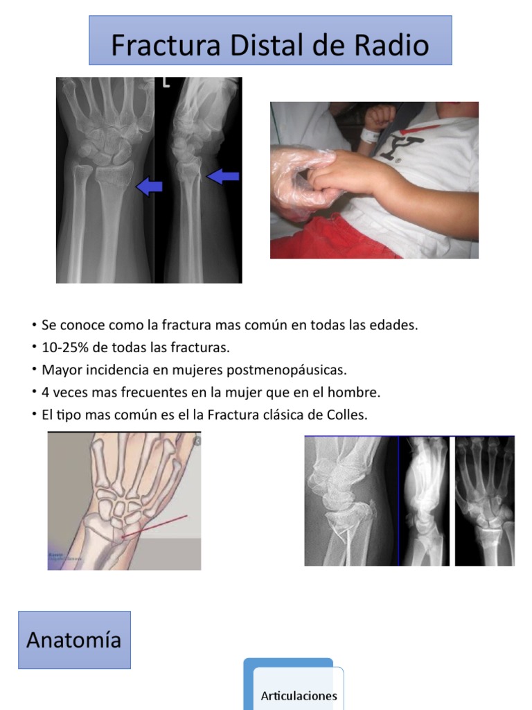 Fractura Distal de Radio | PDF | Hombro | Anatomía humana