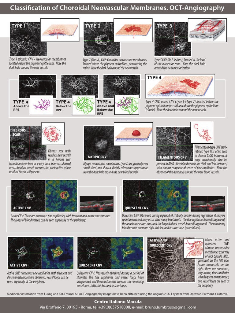 CNV Classification for Eye Specialists | PDF | Retina | Ophthalmology