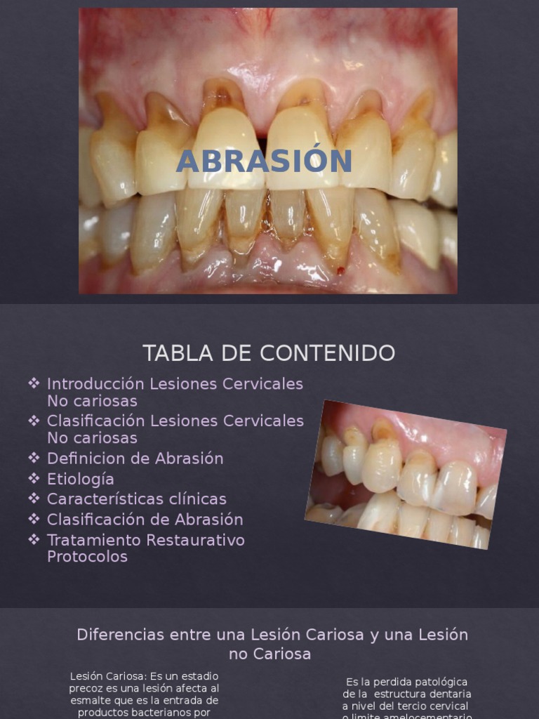 Definición y Causas de la Abrasión Dental | PDF | Esmalte de dientes ...