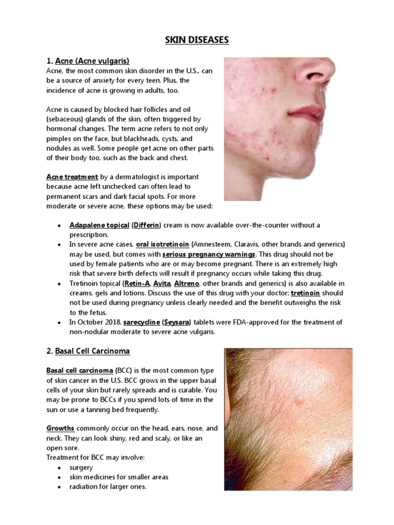 Skin Diseases: 1. Acne (Acne Vulgaris) | PDF | Cutaneous Conditions ...