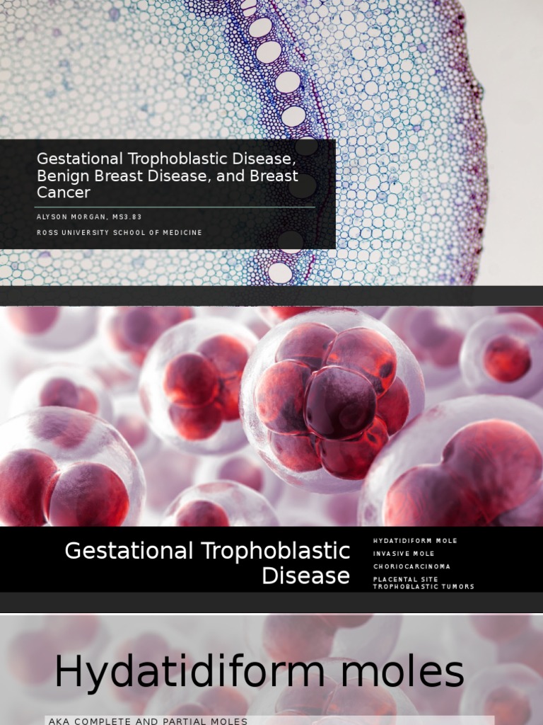 GTD, Benign Breast, and Breast Cancer | PDF | Mammalian Pregnancy ...