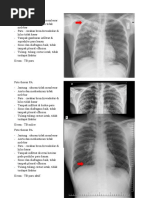 Evaluasi Foto Thorax Normal dan Abnormal | PDF