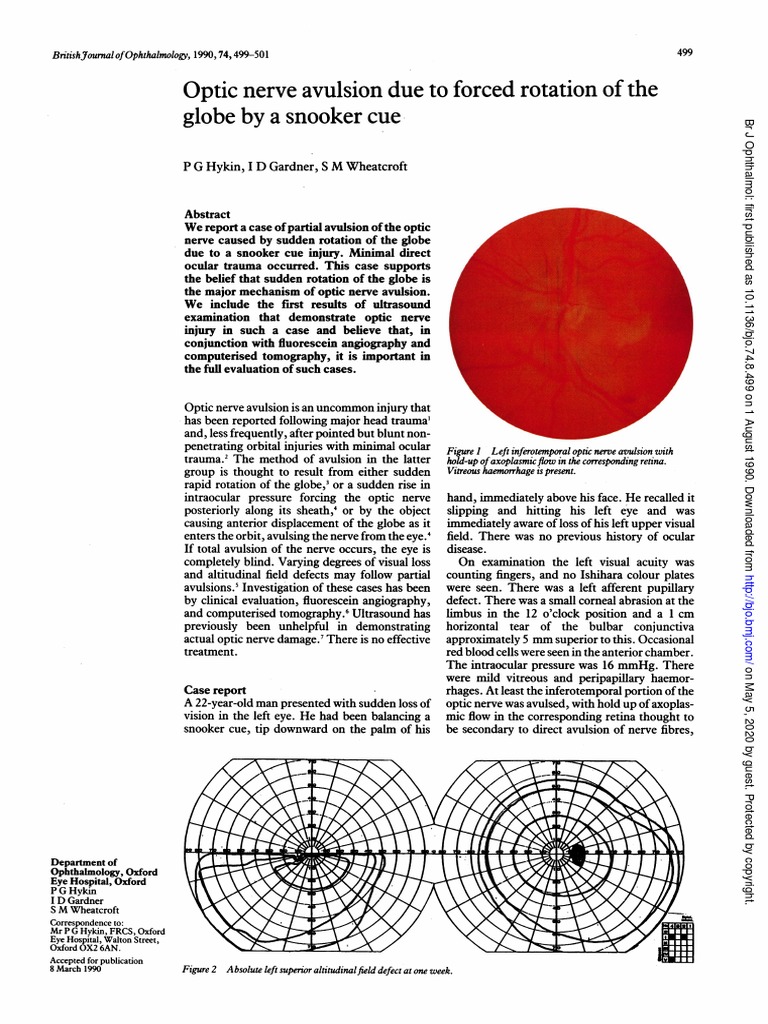 Optic Nerve Avulsion Due To Forced Rotation of The Globe by A Snooker ...