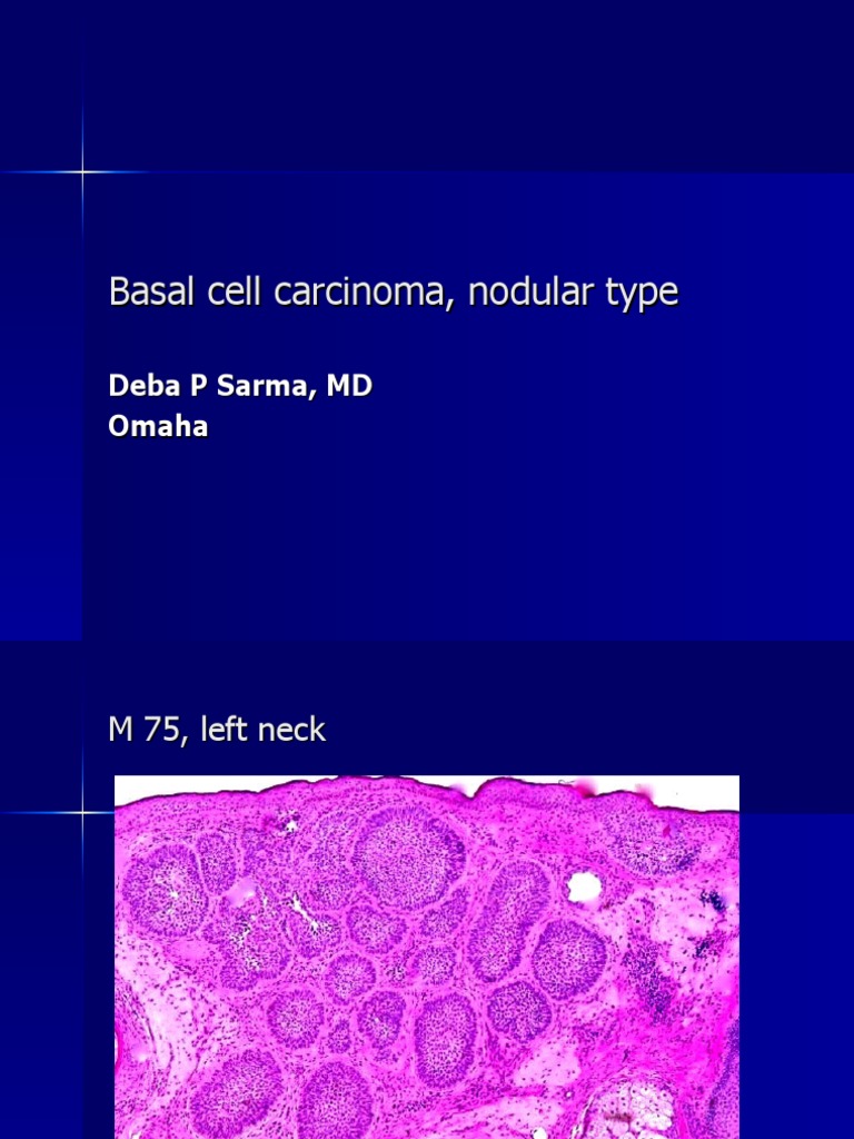 Nodular Basal Cell Carcinoma Overview | PDF