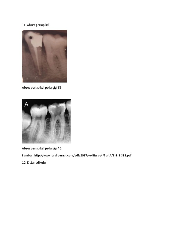 Abses Periapikal | PDF