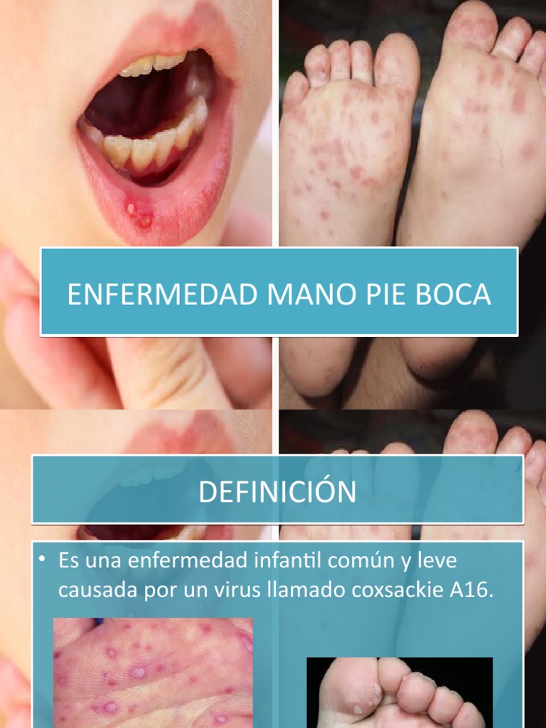 Enfermedad Mano Pie Boca | PDF