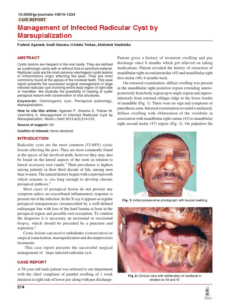 Management of Infected Radicular Cyst by Marsupialization: Case Report ...