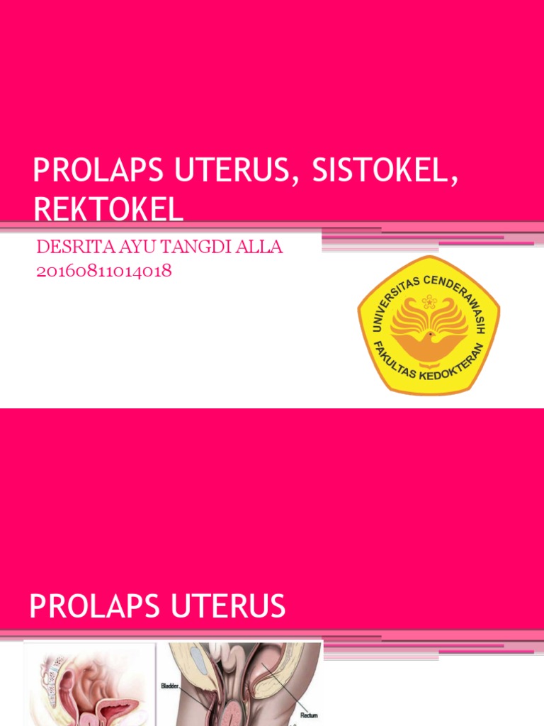 Desrita Ayu Tangdi Alla PPT Prolaps Uterus, Sistokel, Rektokel | PDF