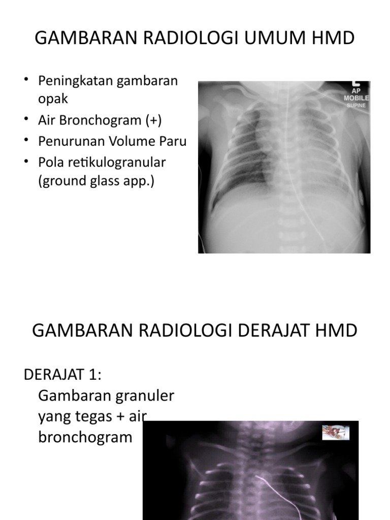 Dokumen - Tips - Gambaran Radiologi Umum HMD | PDF | Teknologi & Rekayasa