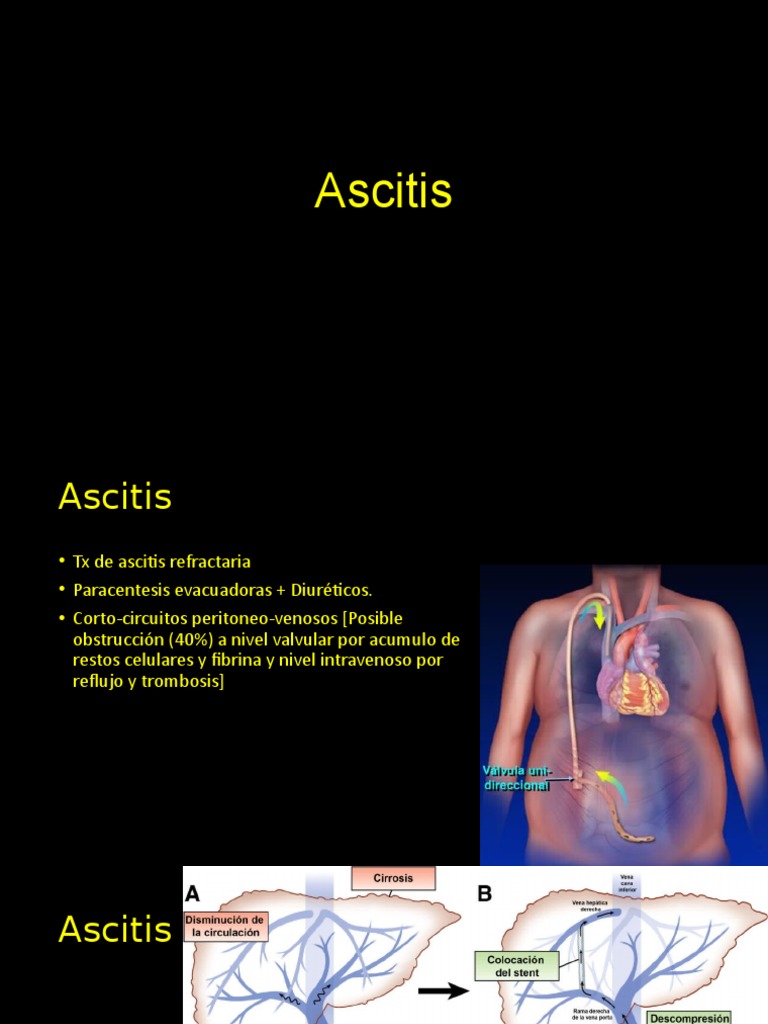 Tratamiento de la Ascitis Refractaria | PDF | Las bacterias | Epidemiología