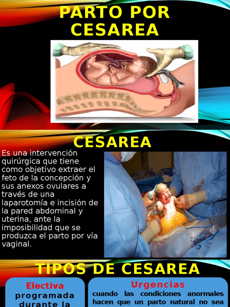 Tipos y Procedimiento de Cesárea | PDF | Seccion de cesárea | Parto