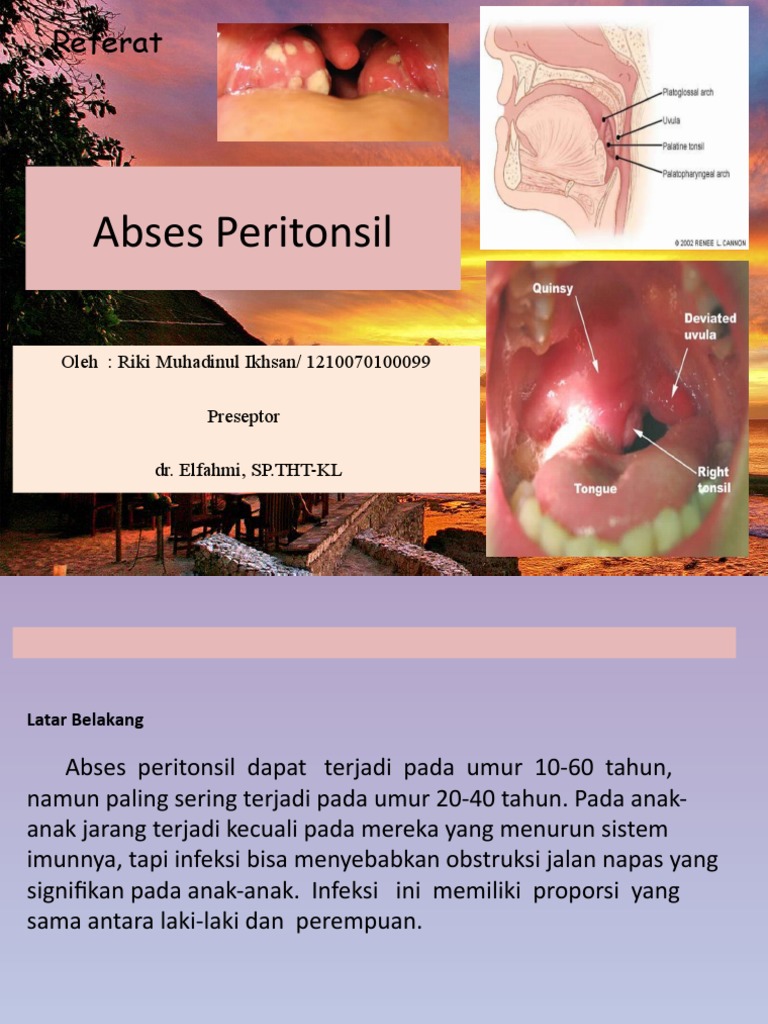 Abses Peritonsil | PDF