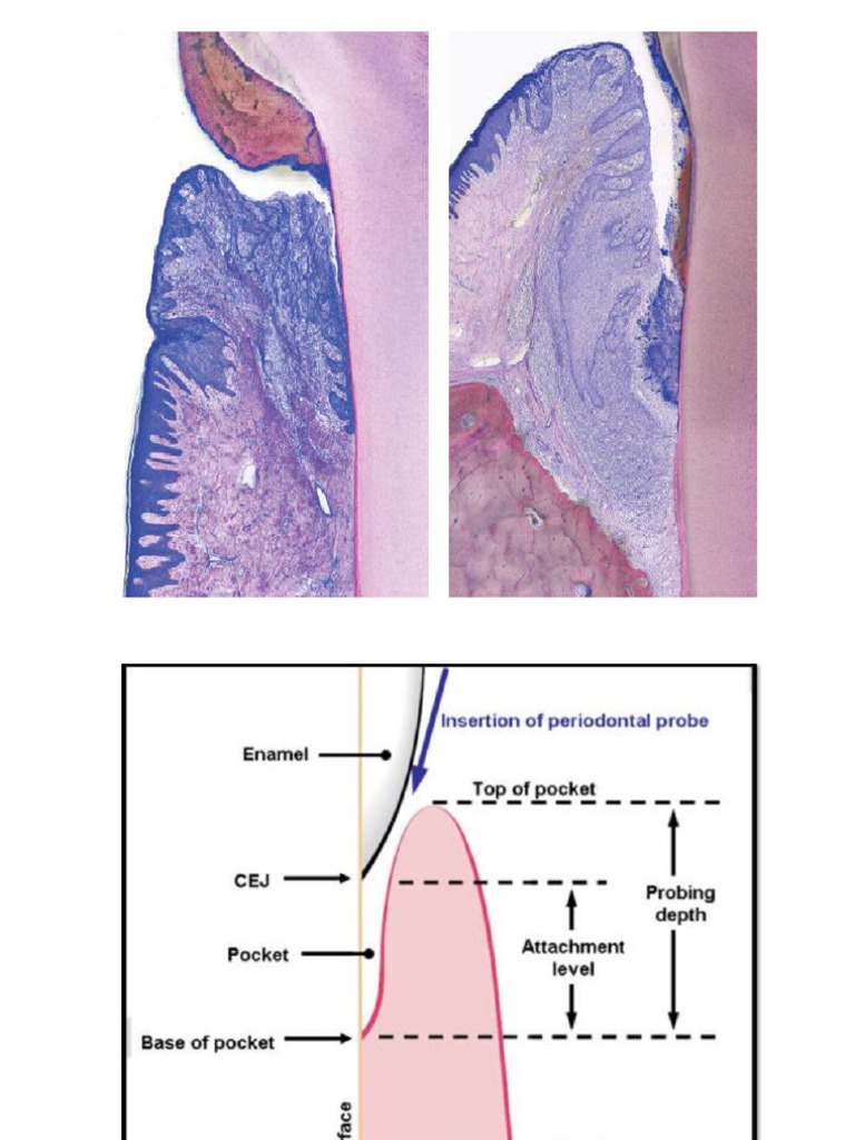 Understanding Periodontal Pocket Formation | PDF | Periodontology ...