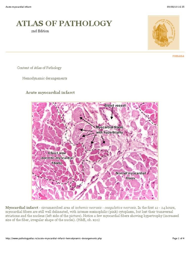Atlas of Pathology: 2nd Edition | PDF | Cardiac Muscle | Myocardial ...