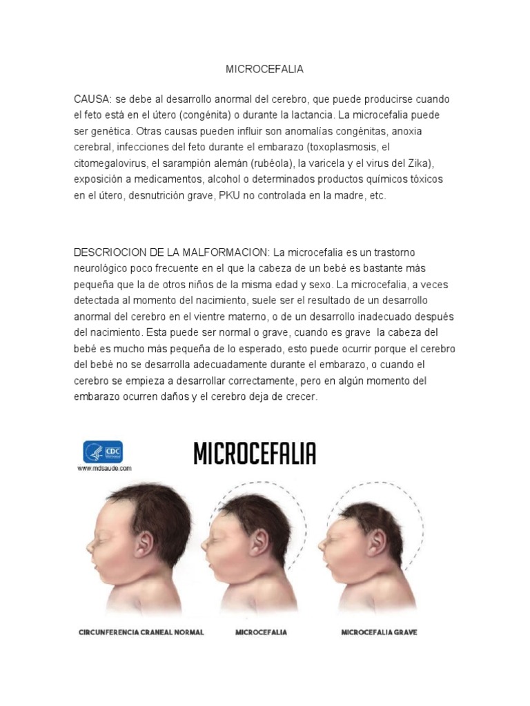 MICROCEFALIA | PDF | Infantes | El embarazo